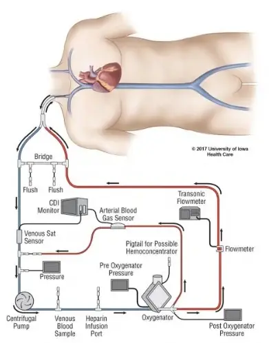 ทำความรู้จัก ECMO เครื่องหัวใจ-ปอดเทียมแบบเคลื่อนย้าย