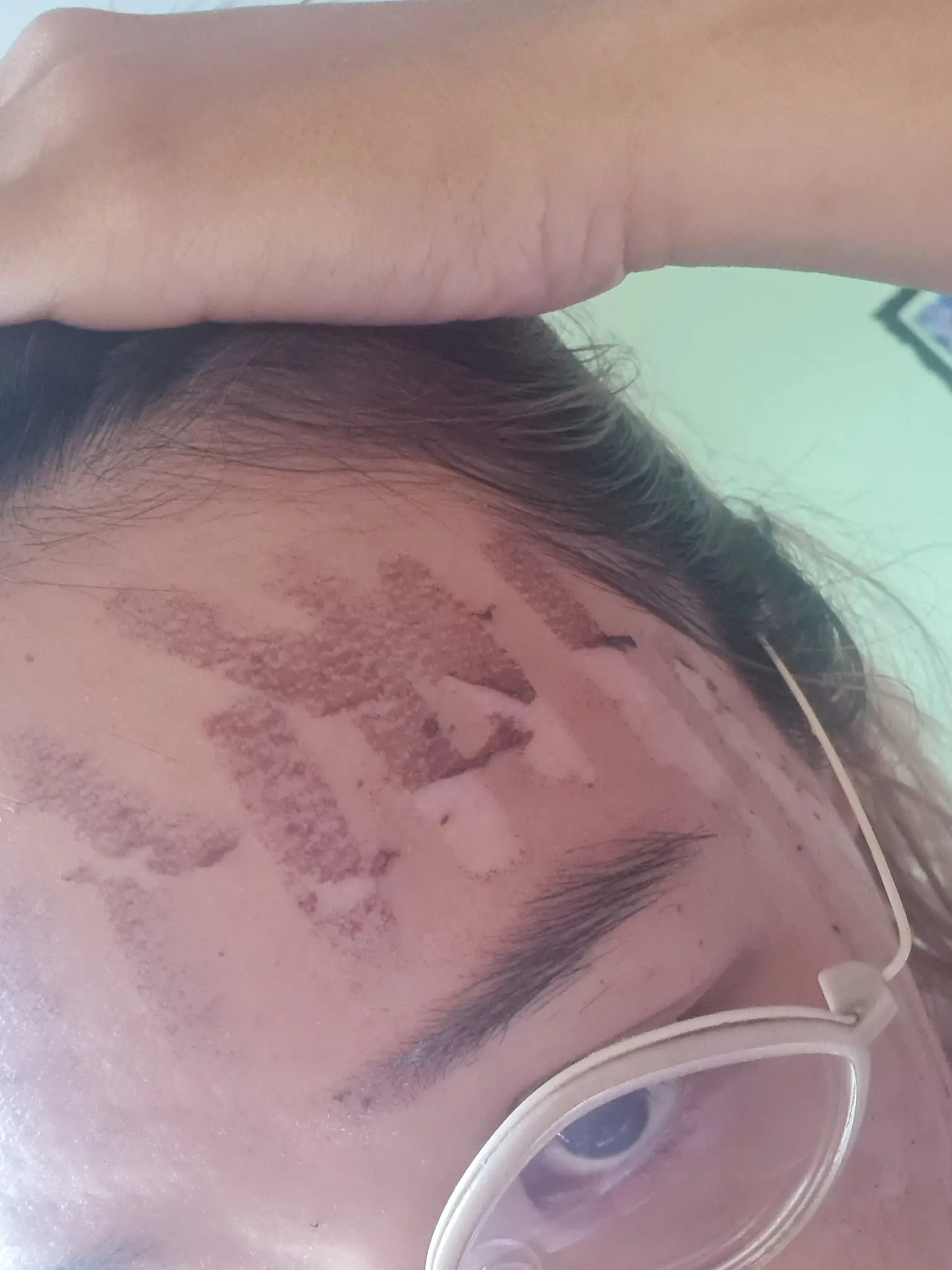 สยอง! สาวแชร์ประสบการณ์ 'หน้าพัง' หลังเลเซอร์หน้าที่คลินิกชื่อดัง